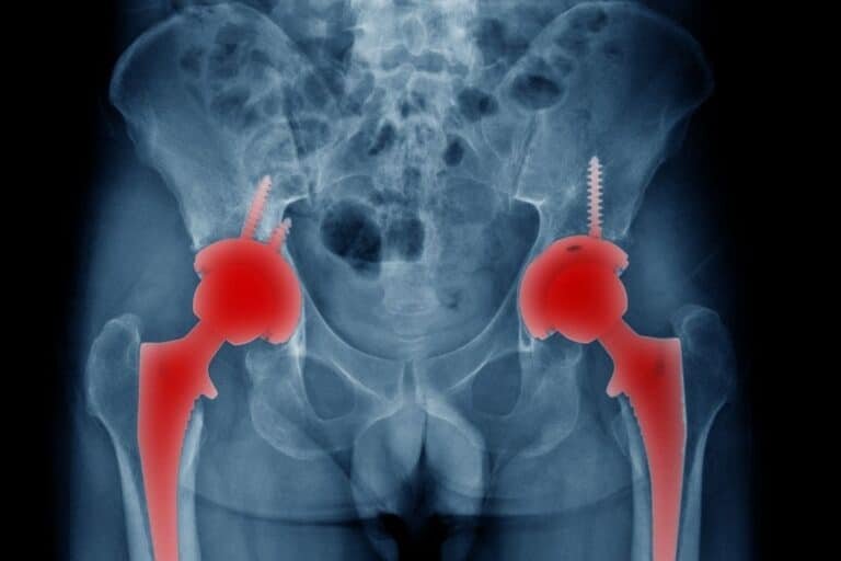 Hip Replacement Surgery - Cayra Clinic