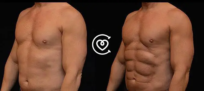Six-Pack Surgery Istanbul & Antalya. Define Your Abs, Define Yourself.