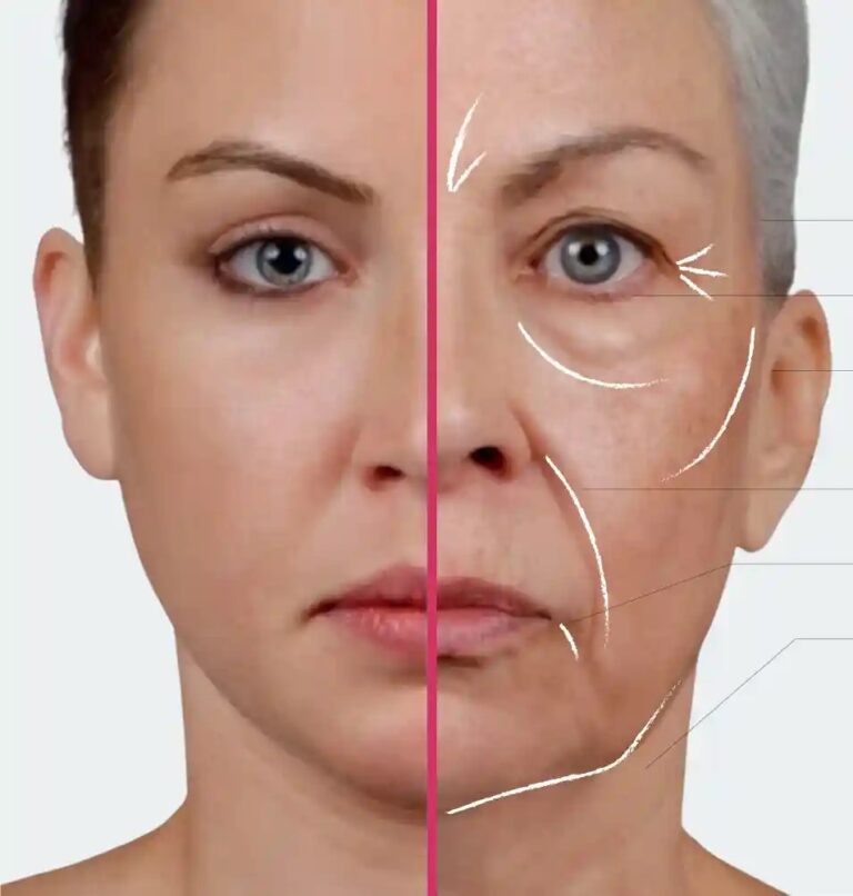 Non-Surgical Facelift For Wrinkles & Sagging Skin