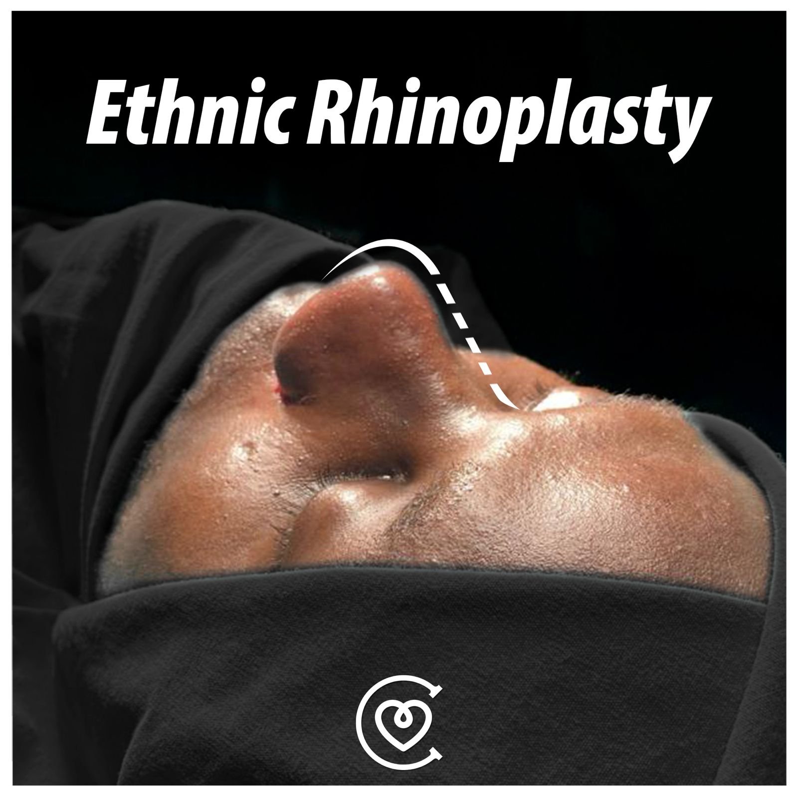 Rhinoplasty Turkey | Natural-Looking Nose Job
